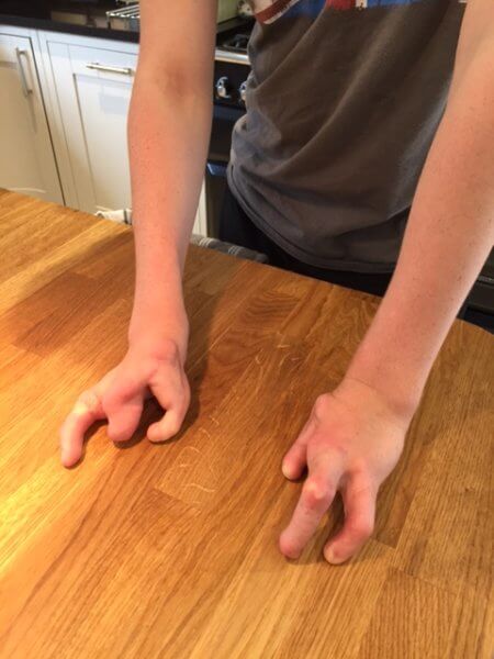 Feet disabilities: para-swim training fins - shinfin™ leg fins